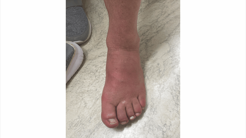 Update Gicht: Diagnose, Akuttherapie und Prophylaxe | mgo medizin